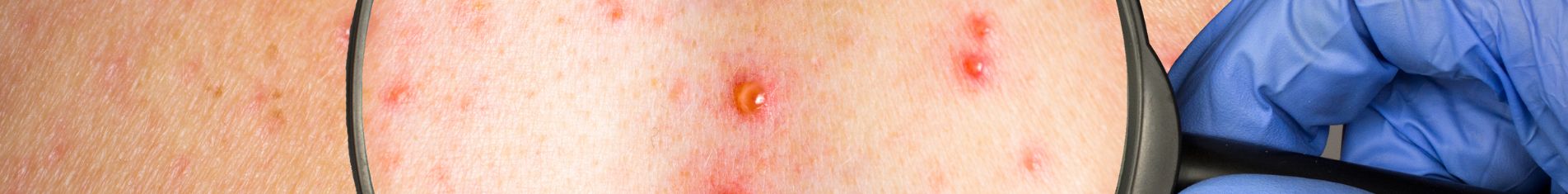 Pharmacy First Shingles Treatment in Stratford-upon-Avon